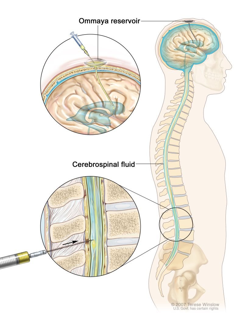 Intrathecal Chemotherapy Methods - Bharat Information